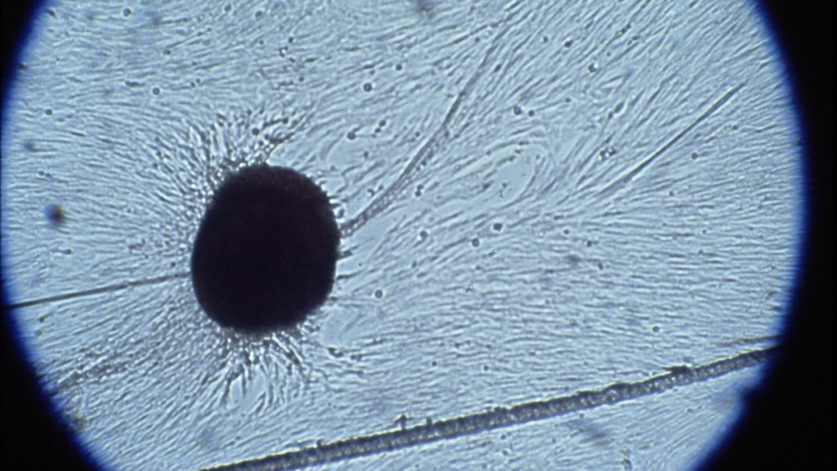 Amniocentesis – Guernica